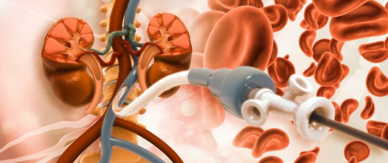Peripheral Arterial Disease Treatment | NEPA Vascular